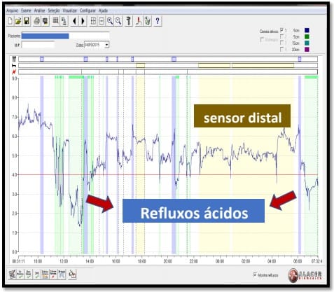Phmetria Esofágica Computadorizada 24hs – CEFIDI