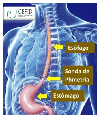 Phmetria Esofágica Computadorizada 24hs – CEFIDI