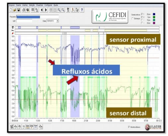 Phmetria Esofágica Computadorizada 24hs – CEFIDI